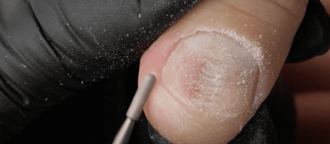 Extremely Bitten Nail To Long Transformation Using Japanese Gel – Paola ...